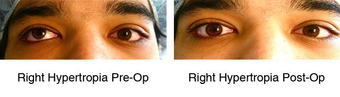 Hypertropia Eye